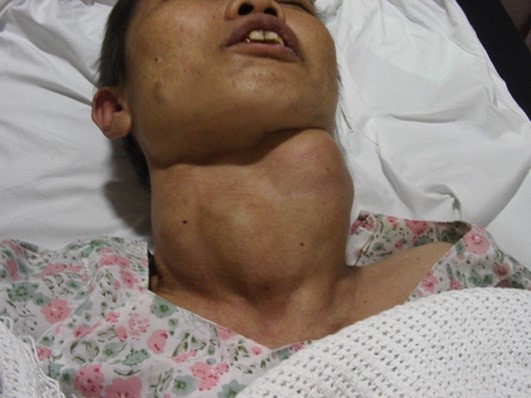 Thyroid – Charles Tan Surgery